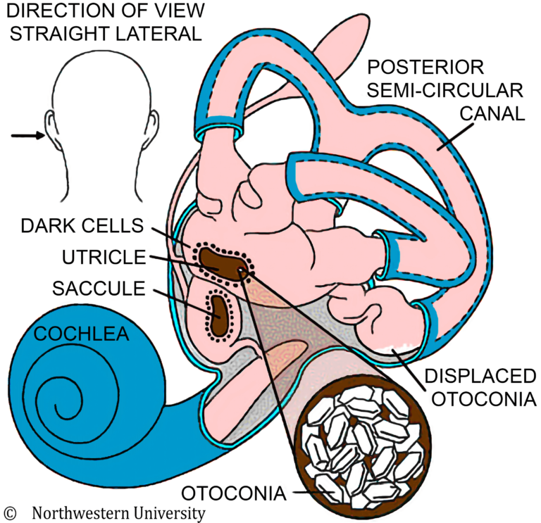 Benign paroxysmal positional vertigo – Ear Nose and Throat